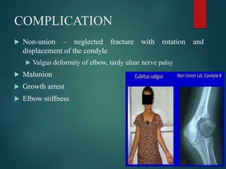 Lateral condyle fracture humerus | PPTX