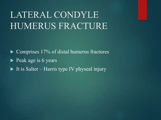 Lateral condyle fracture humerus | PPTX