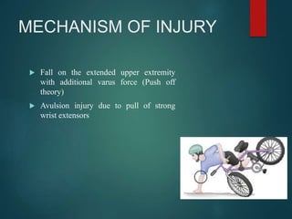 Lateral condyle fracture humerus | PPTX