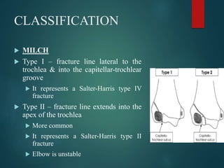 Lateral condyle fracture humerus | PPTX