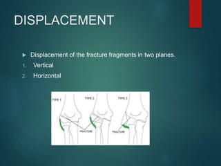 Lateral condyle fracture humerus | PPTX