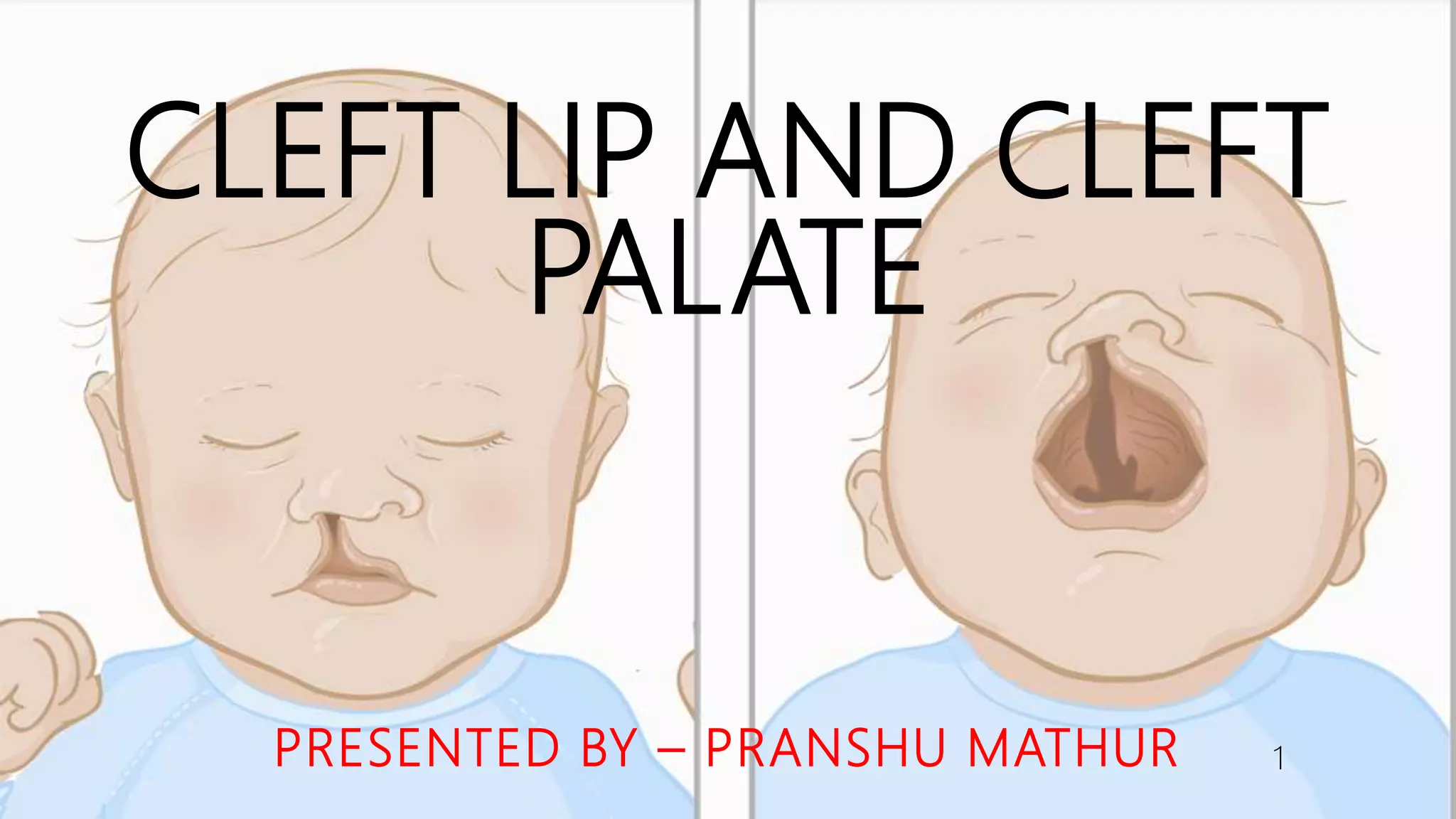 Cleft Lip and Cleft Palate | PPTX | Ear, Nose and Throat Conditions | Diseases and Conditions
