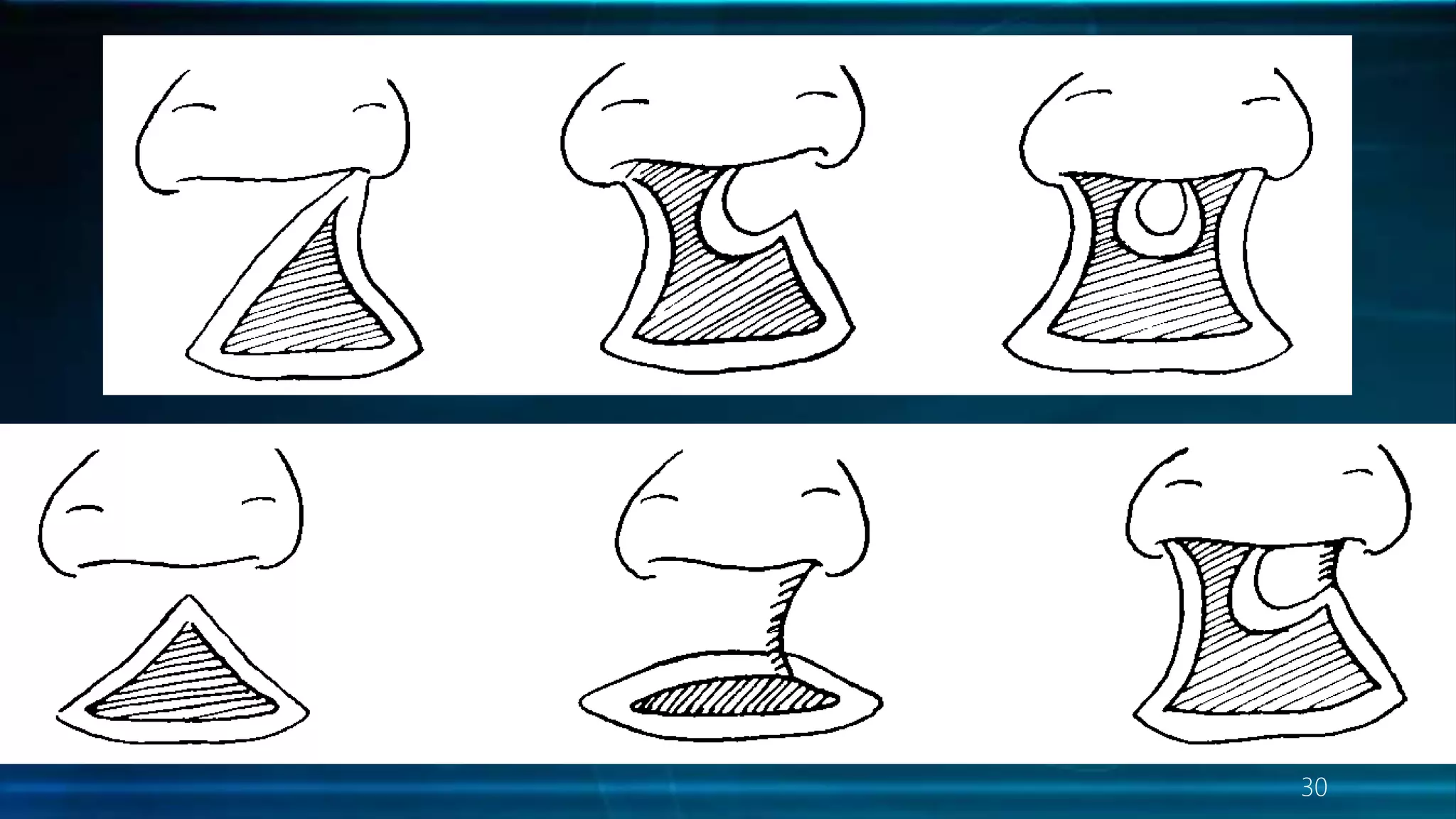 Cleft Lip and Cleft Palate | PPTX | Ear, Nose and Throat Conditions ...