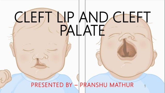 Cleft Lip and Cleft Palate | PPTX | Ear, Nose and Throat Conditions ...