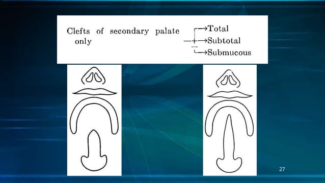 Cleft Lip and Cleft Palate | PPTX | Ear, Nose and Throat Conditions ...