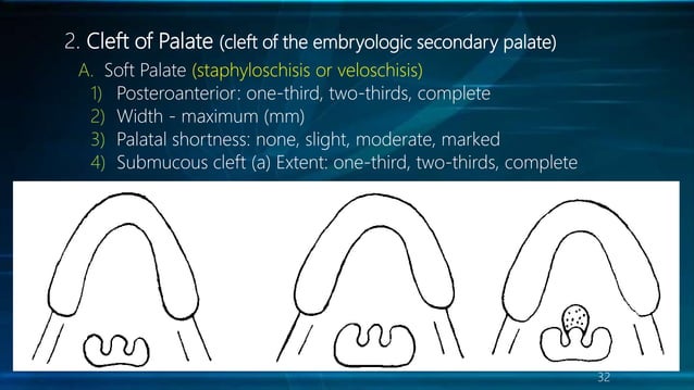 Cleft Lip and Cleft Palate | PPTX | Ear, Nose and Throat Conditions ...