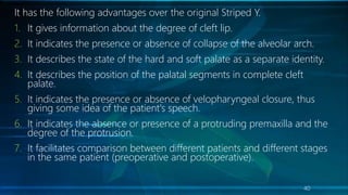 Cleft Lip and Cleft Palate | PPTX