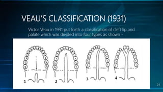 Cleft Lip and Cleft Palate | PPT