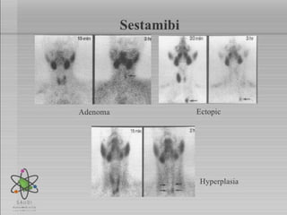 parathyroid scan | PPT