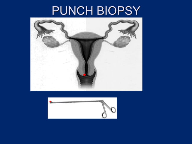 6 Cancer Of Uterine Cervix Ifakara Ppt