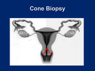 6. cancer of uterine cervix ifakara | PPT | Reproductive Health ...