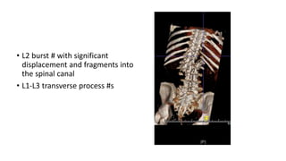 Surgical considerations in the injured spine patient | PPT