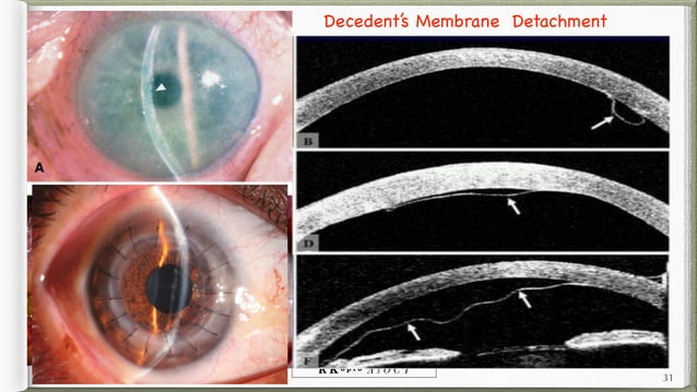 Optical Coherence Tomography (OCT) Anterior & Posterior | PDF