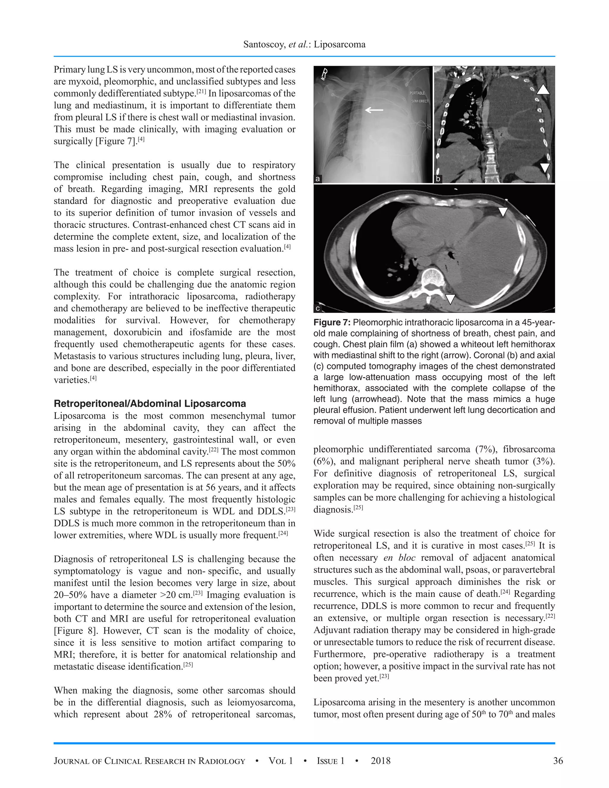 Liposarcoma: A Pictorial and Literature Review | PDF