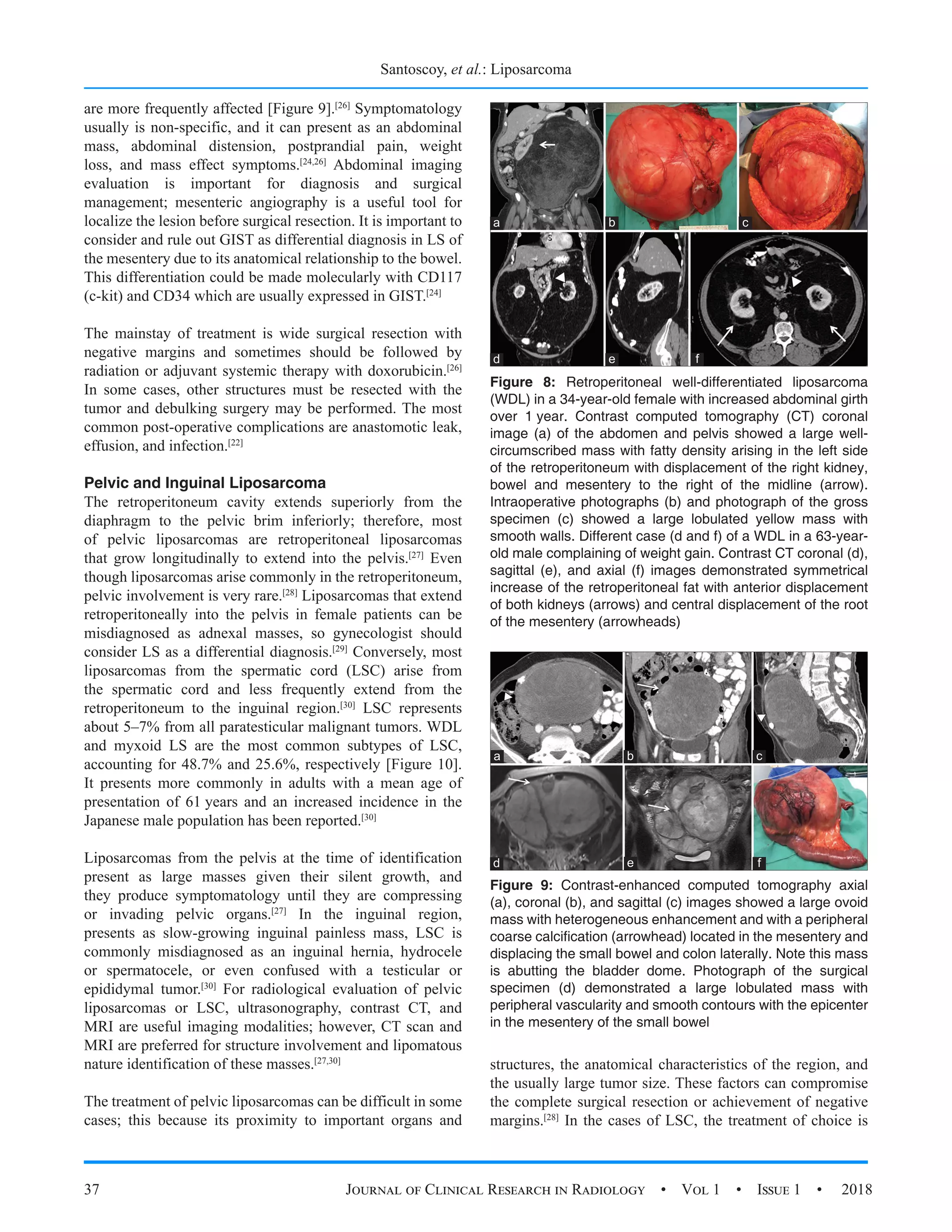 Liposarcoma: A Pictorial and Literature Review | PDF