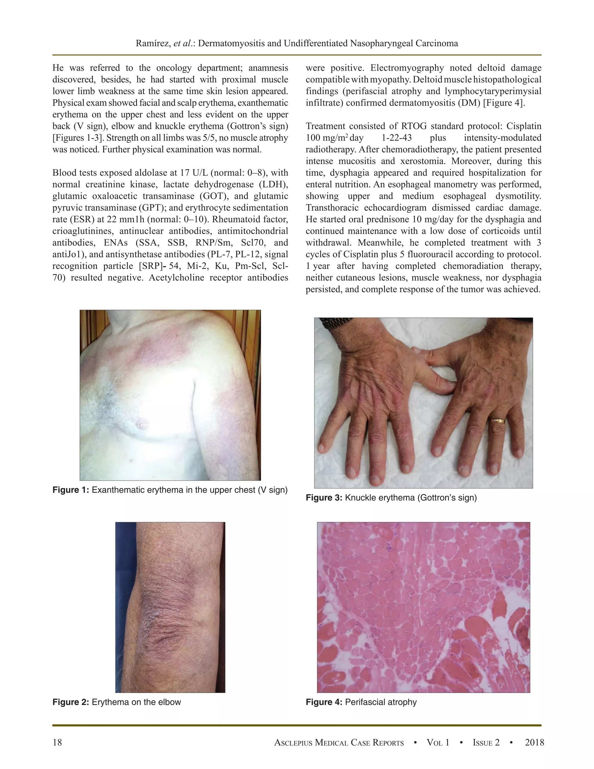 Dermatomyositis and Undifferentiated Nasopharyngeal Carcinoma. A Rare ...