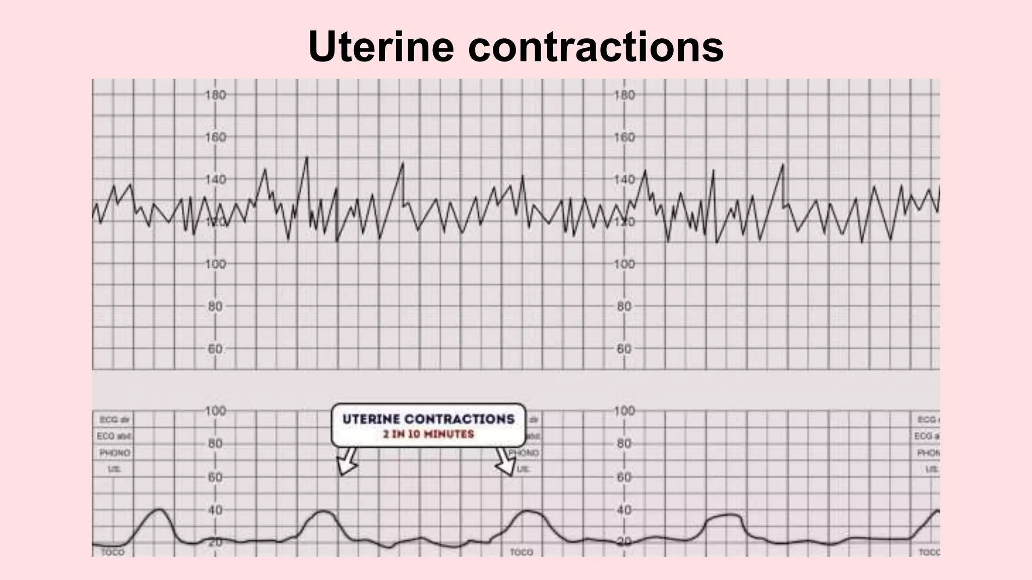 Cardiotocography (CTG).pptx
