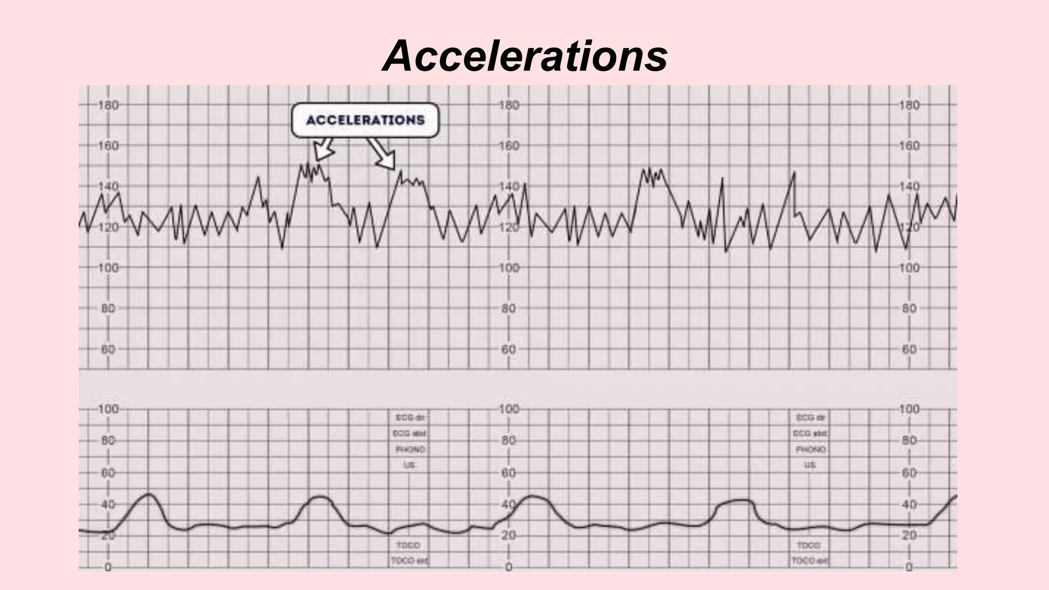 Cardiotocography (CTG).pptx