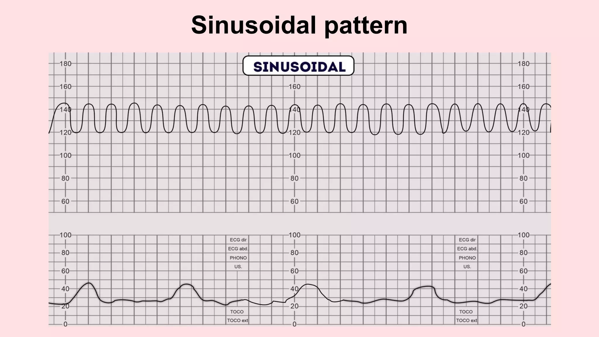 Cardiotocography (CTG).pptx