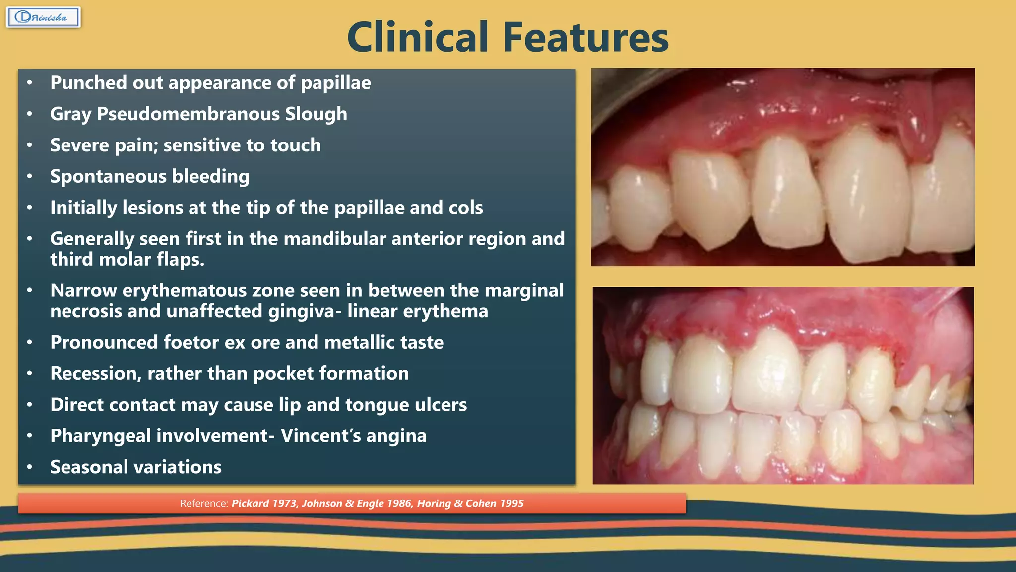 Acute Gingival Infections.pptx