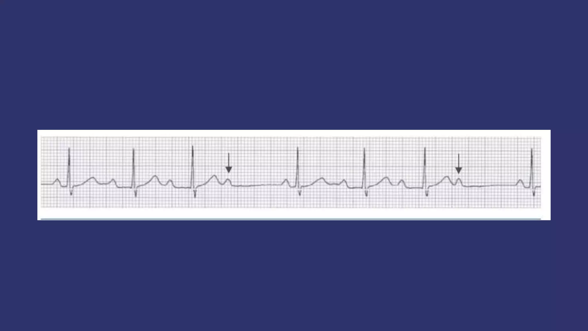ATRIOVENTRICULAR BLOCKS.pptx