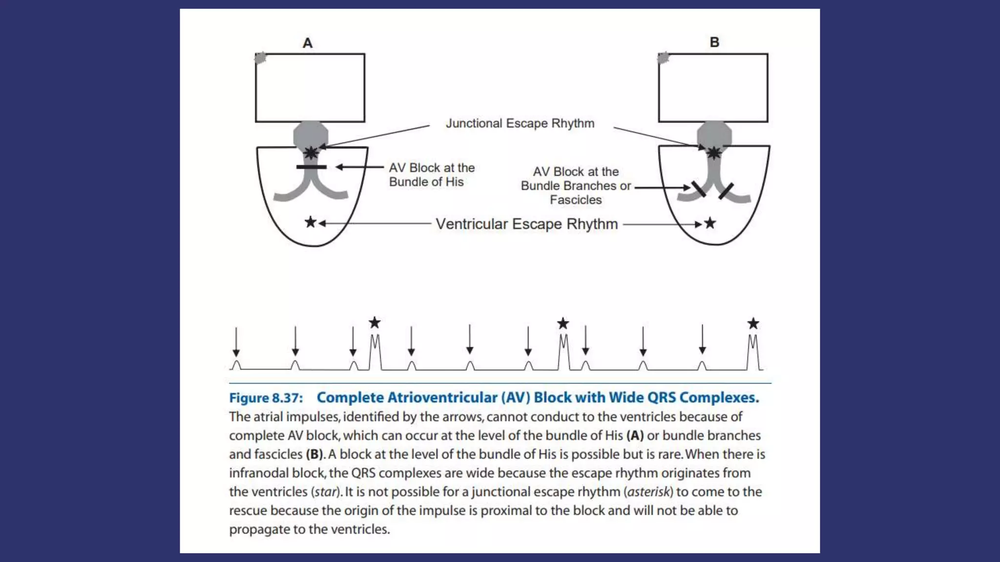 ATRIOVENTRICULAR BLOCKS.pptx