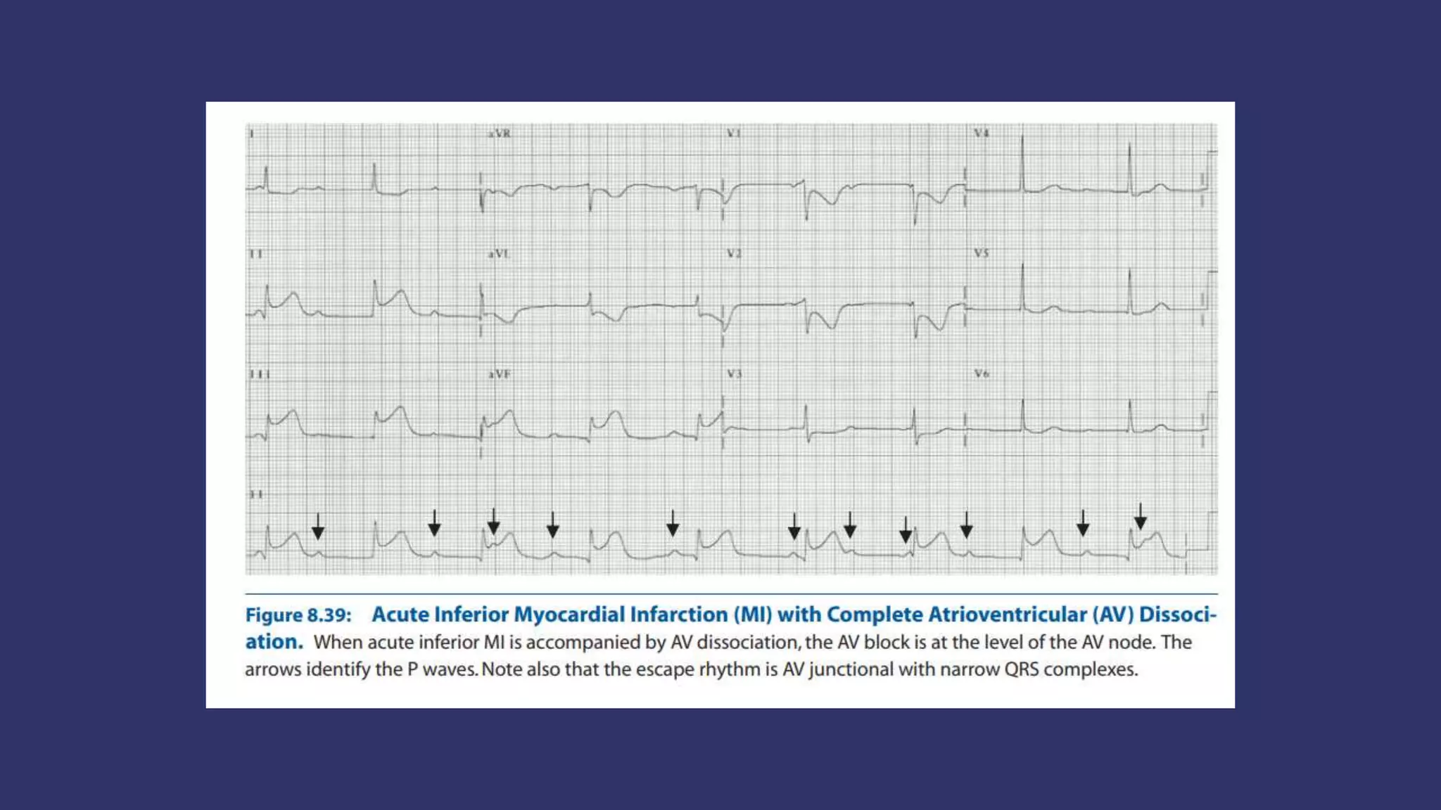 ATRIOVENTRICULAR BLOCKS.pptx