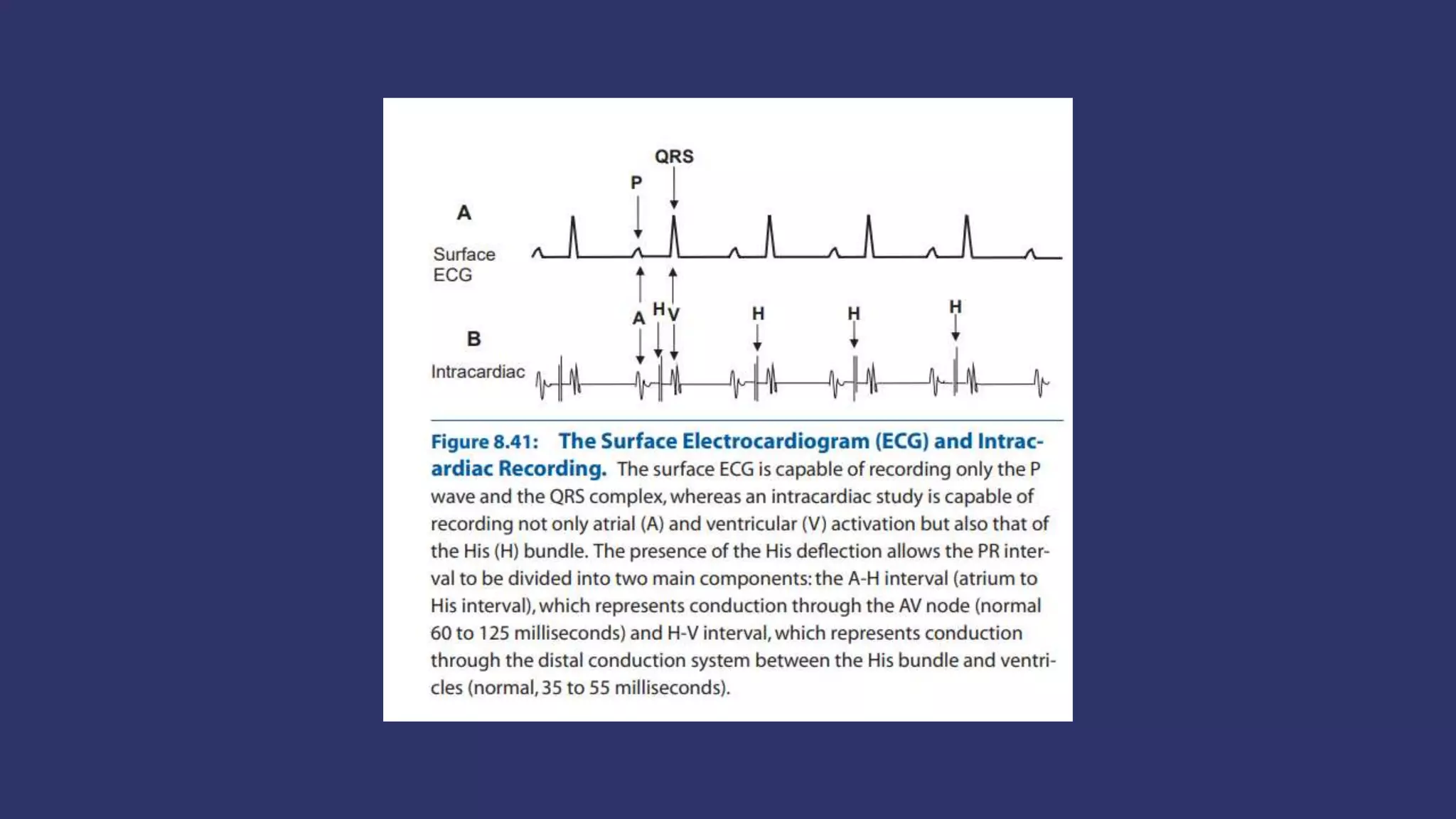 ATRIOVENTRICULAR BLOCKS.pptx