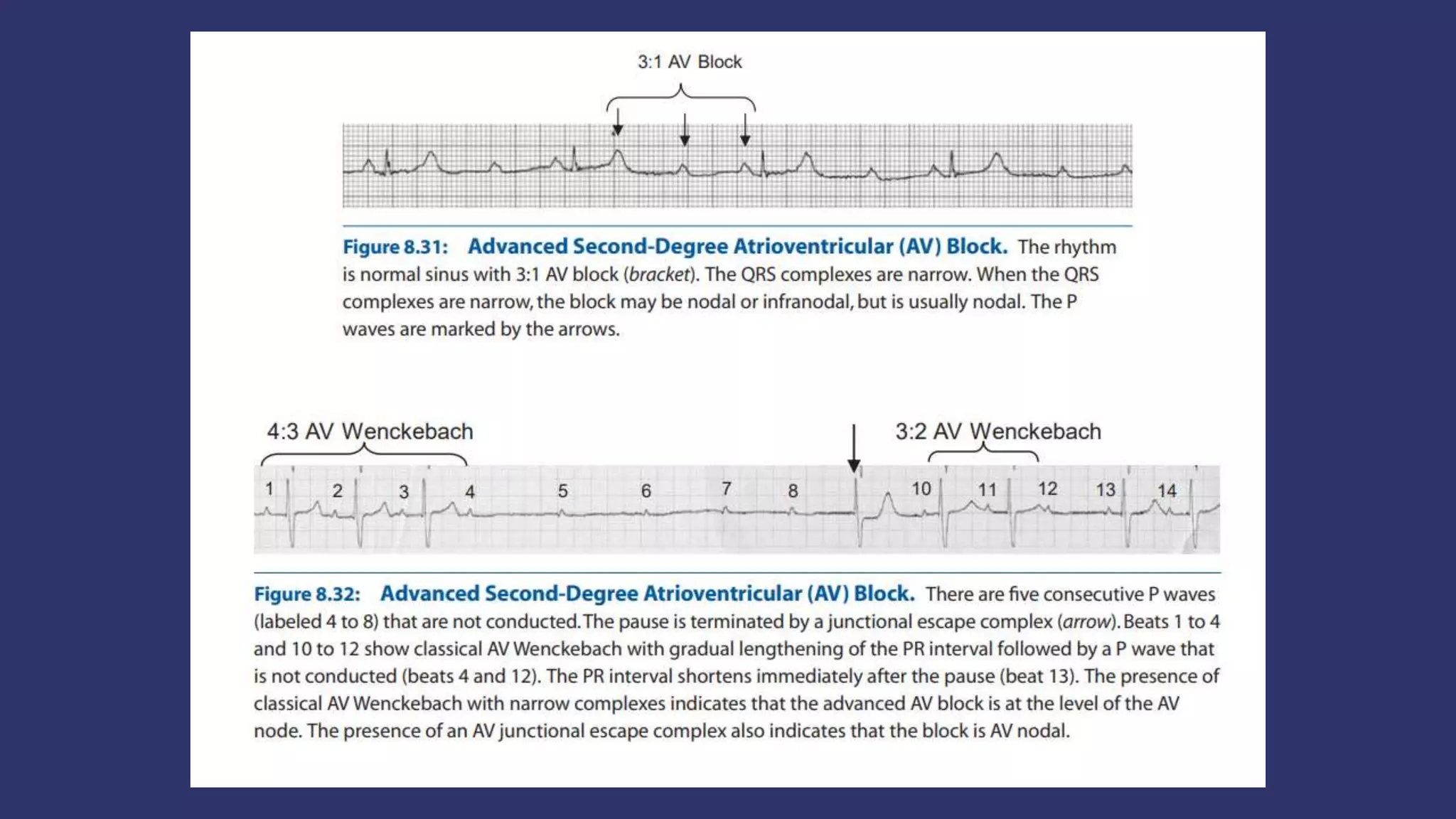 ATRIOVENTRICULAR BLOCKS.pptx