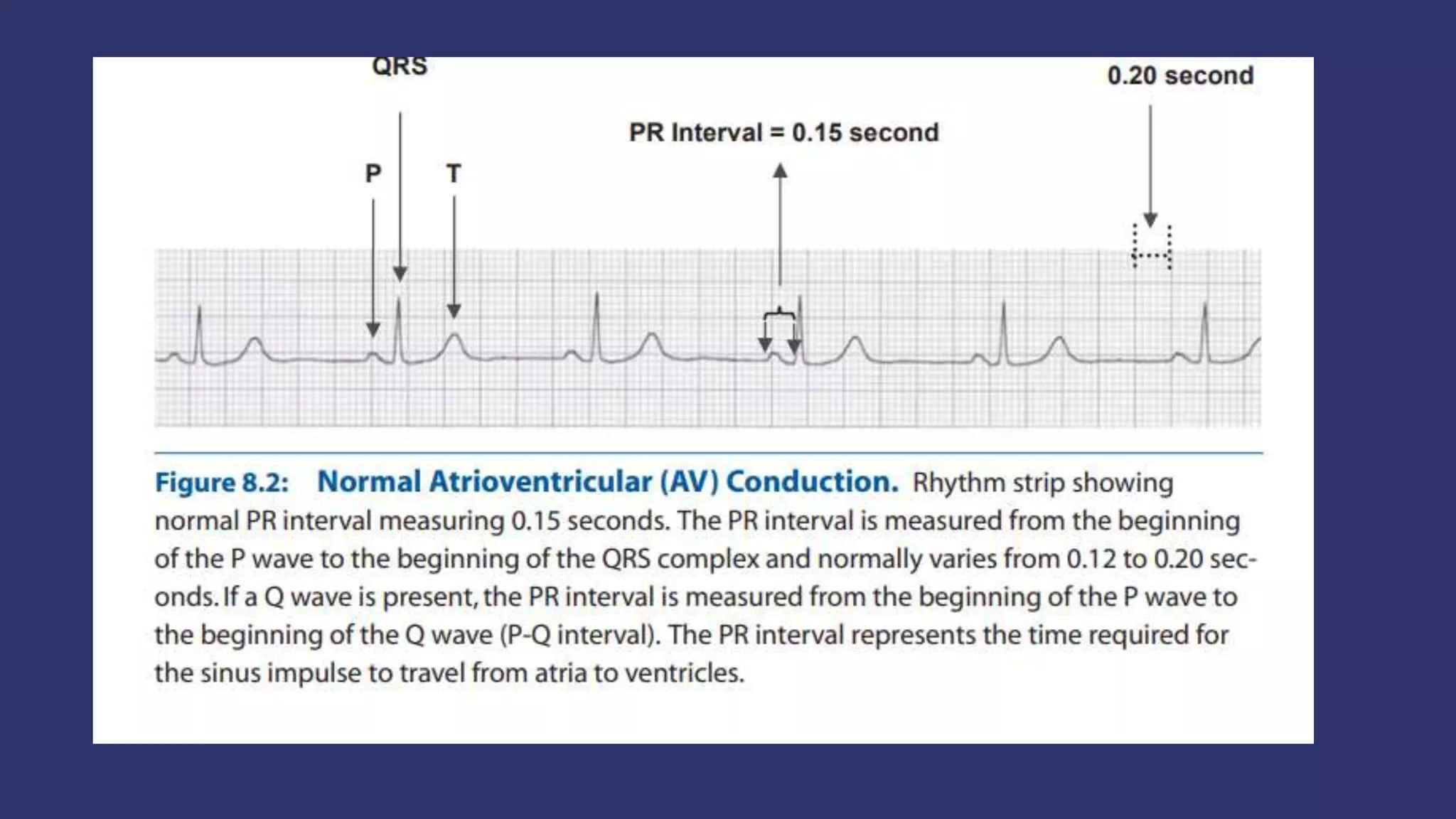 ATRIOVENTRICULAR BLOCKS.pptx