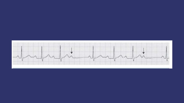 ATRIOVENTRICULAR BLOCKS.pptx