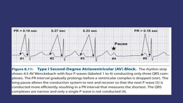 ATRIOVENTRICULAR BLOCKS.pptx
