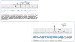 ATRIOVENTRICULAR BLOCKS.pptx