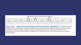 ATRIOVENTRICULAR BLOCKS.pptx