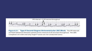 ATRIOVENTRICULAR BLOCKS.pptx