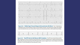 ATRIOVENTRICULAR BLOCKS.pptx