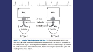 ATRIOVENTRICULAR BLOCKS.pptx