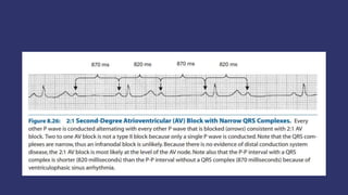 ATRIOVENTRICULAR BLOCKS.pptx