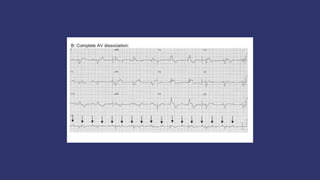 ATRIOVENTRICULAR BLOCKS.pptx