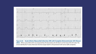 ATRIOVENTRICULAR BLOCKS.pptx