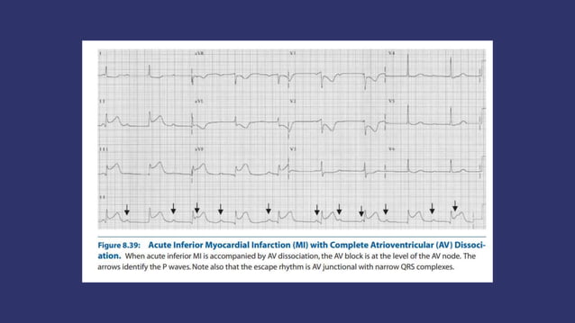 ATRIOVENTRICULAR BLOCKS.pptx