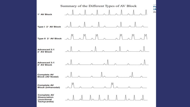 ATRIOVENTRICULAR BLOCKS.pptx