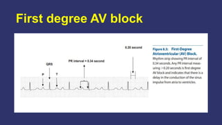 ATRIOVENTRICULAR BLOCKS.pptx