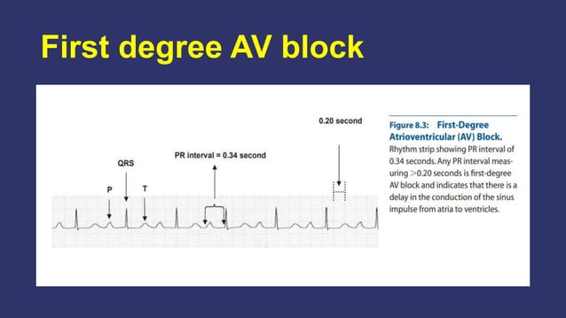 ATRIOVENTRICULAR BLOCKS.pptx
