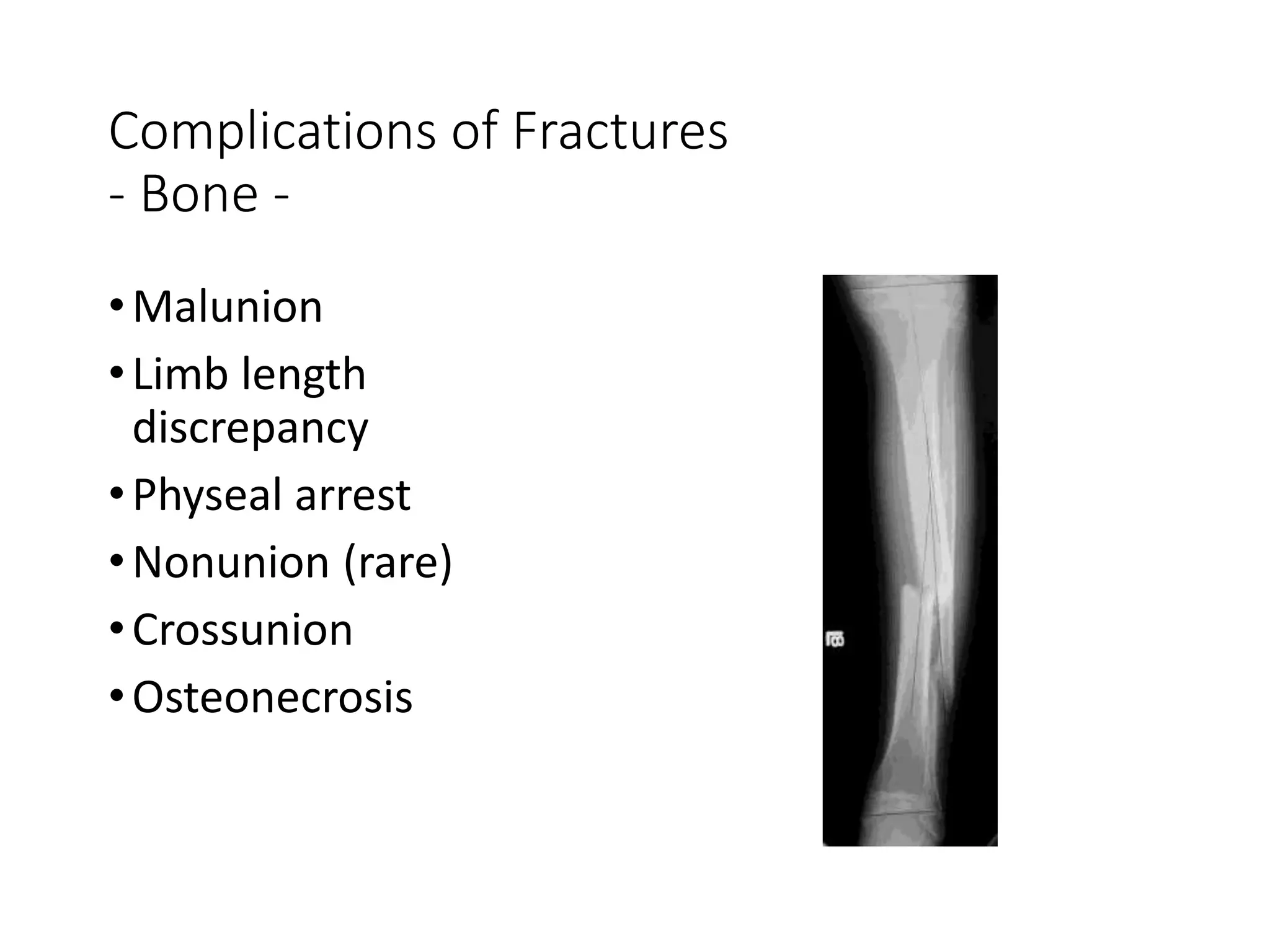 Fractures in children | PPT