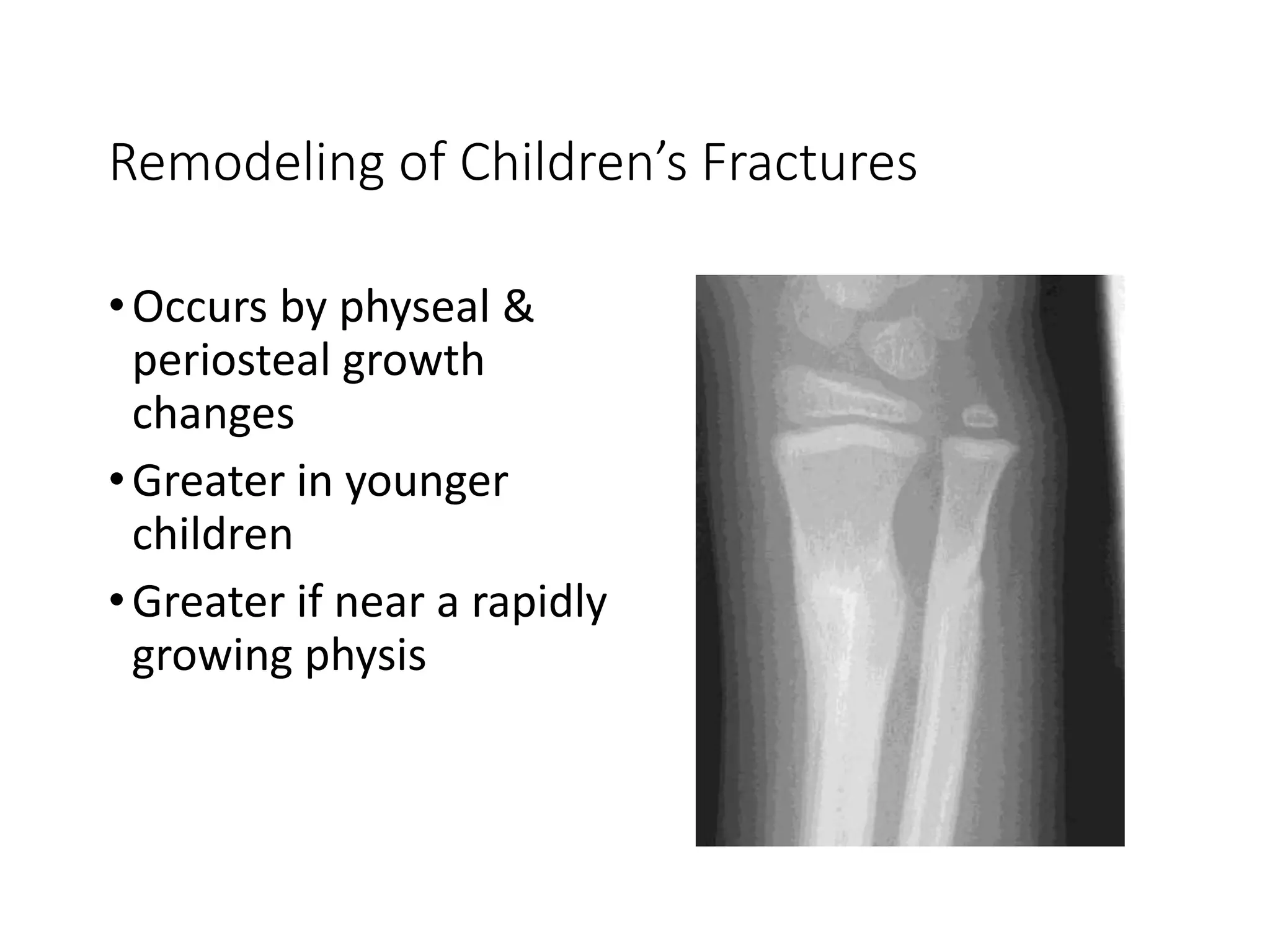 Fractures in children | PPT