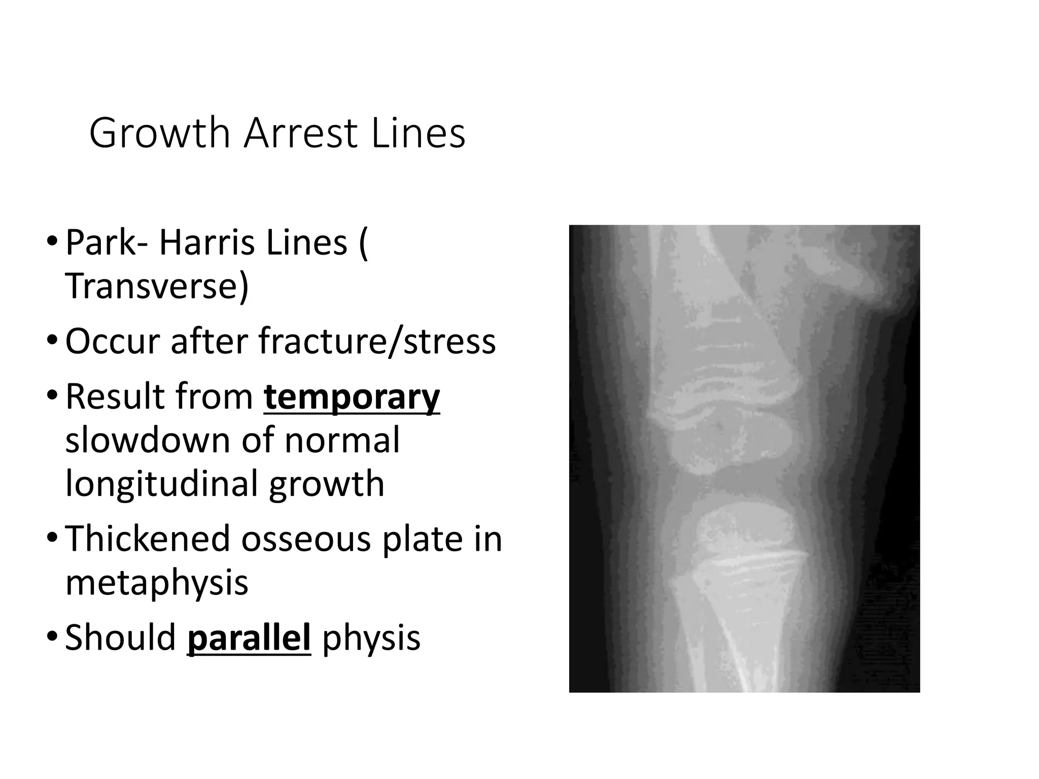 Fractures in children | PPT