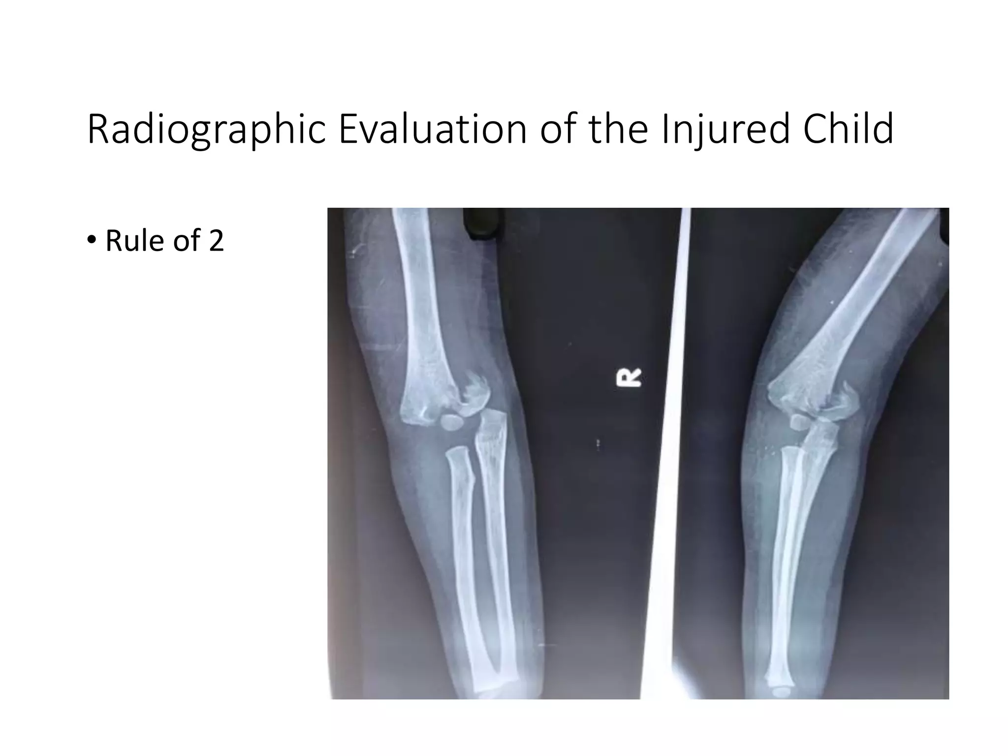 Fractures in children | PPT
