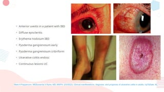 Enfermedad Inflamatoria Intestinal (CUCI y Crohn) y Otros. | PDF