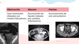 Enfermedad Inflamatoria Intestinal (CUCI y Crohn) y Otros. | PDF